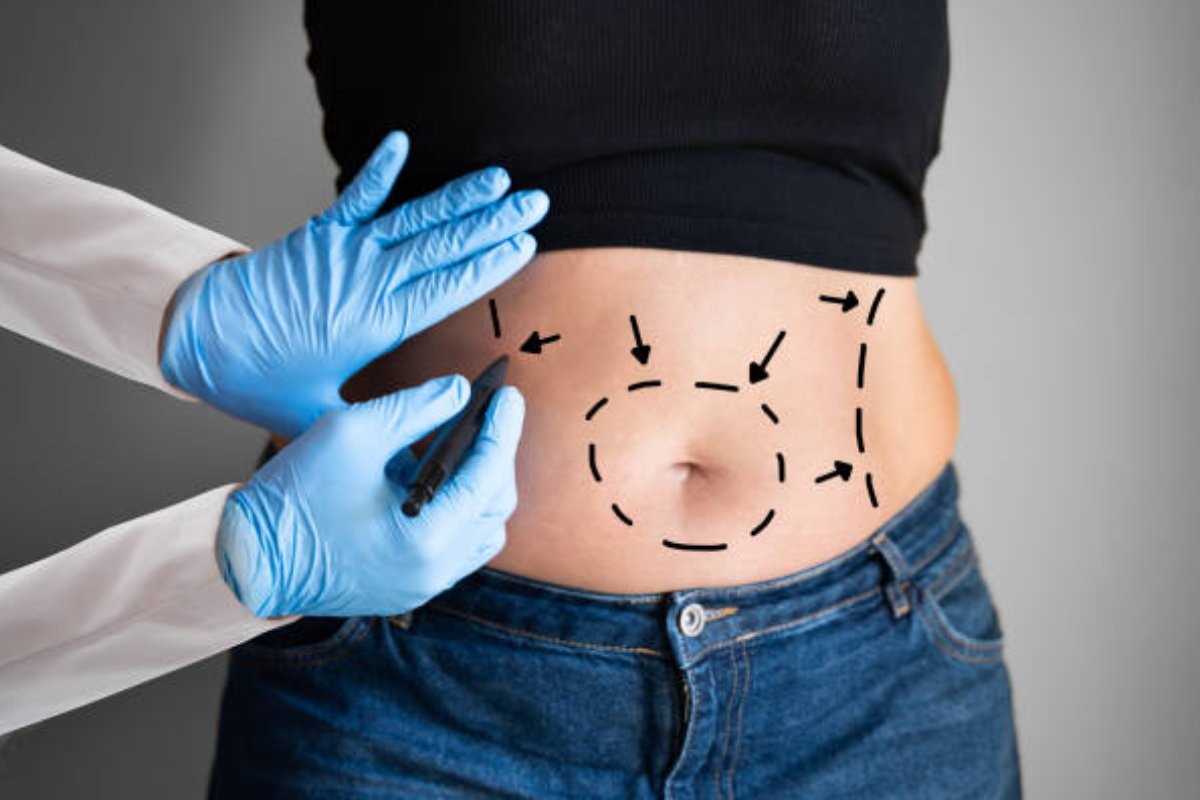 Did You Know That A Tummy Tuck Surgery Can Get You A Snatched Waist In